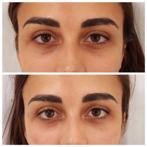Relleno de Ojeras | Precio | Clínica de Medicina Estética Madrid